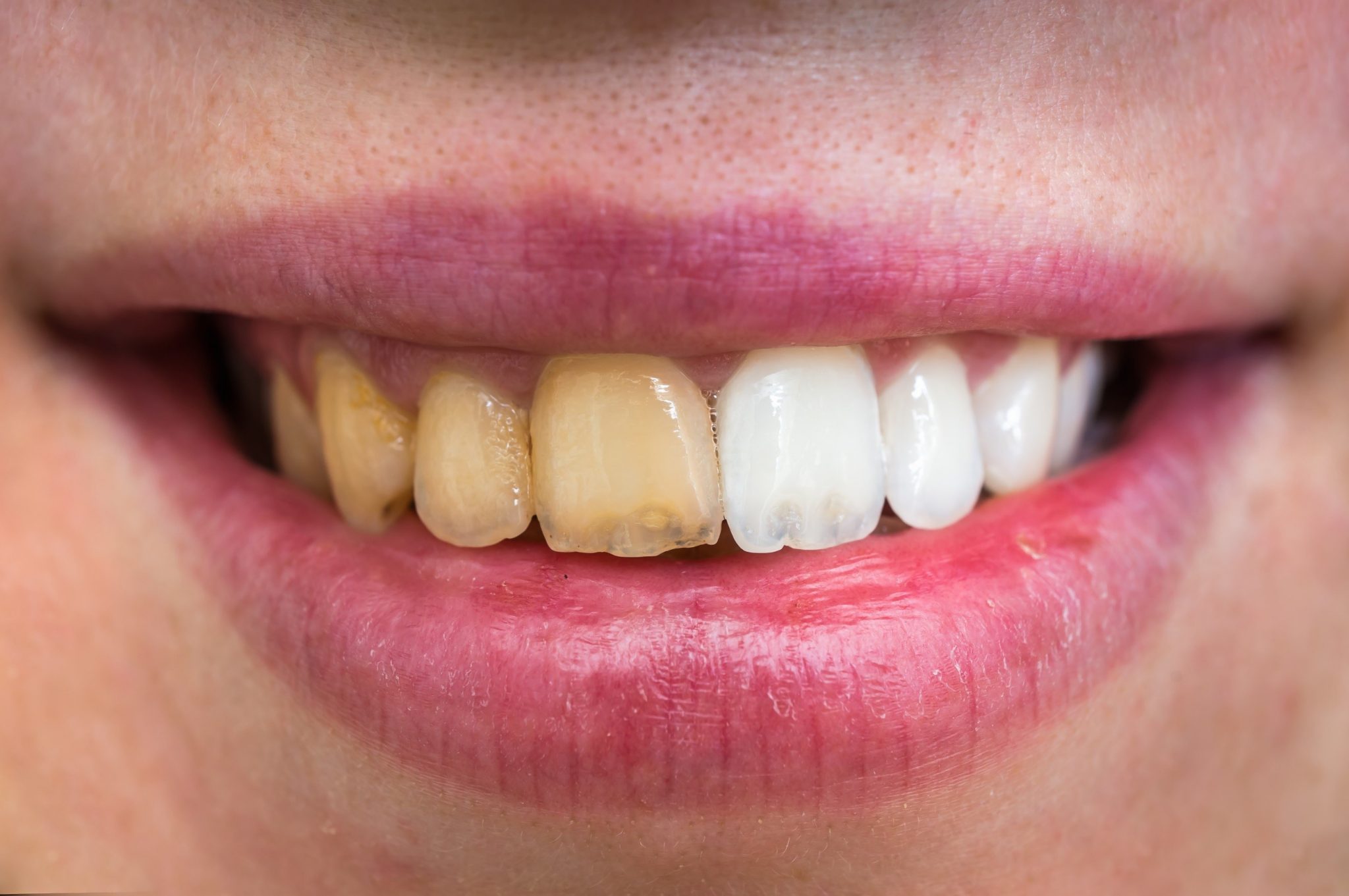 Your Dentist Offers Multiple Teeth Whitening Solutions